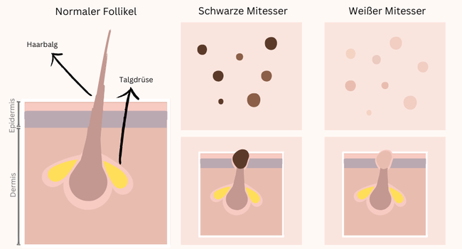 Mitesser entfernen und vorbeugen: So geht's! | Lancôme